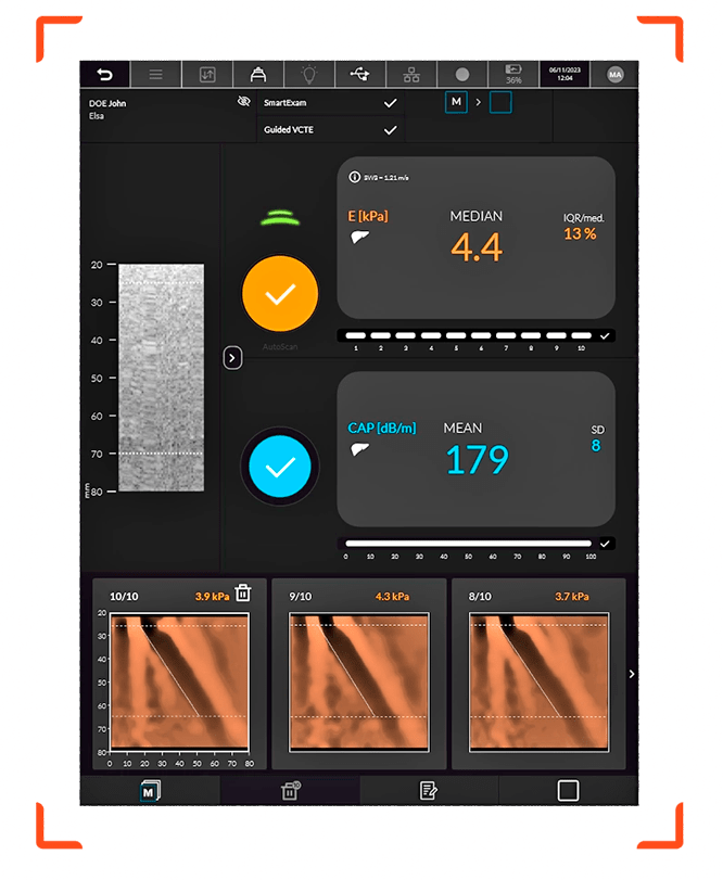 FibroScan® - Scienty-Med